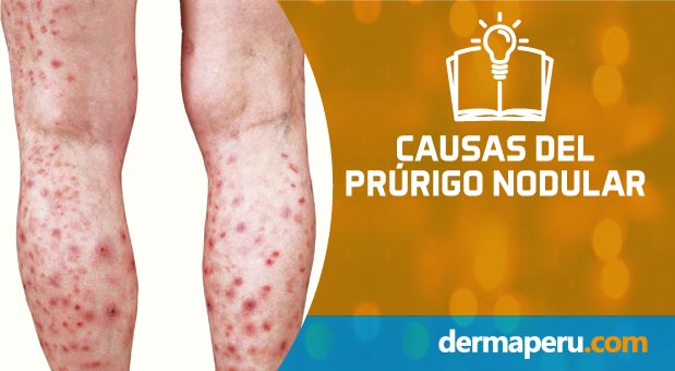 POSIBLES CAUSAS DEL PRÚRIGO NODULAR Y SUS CONSECUENCIAS | Dermaperú